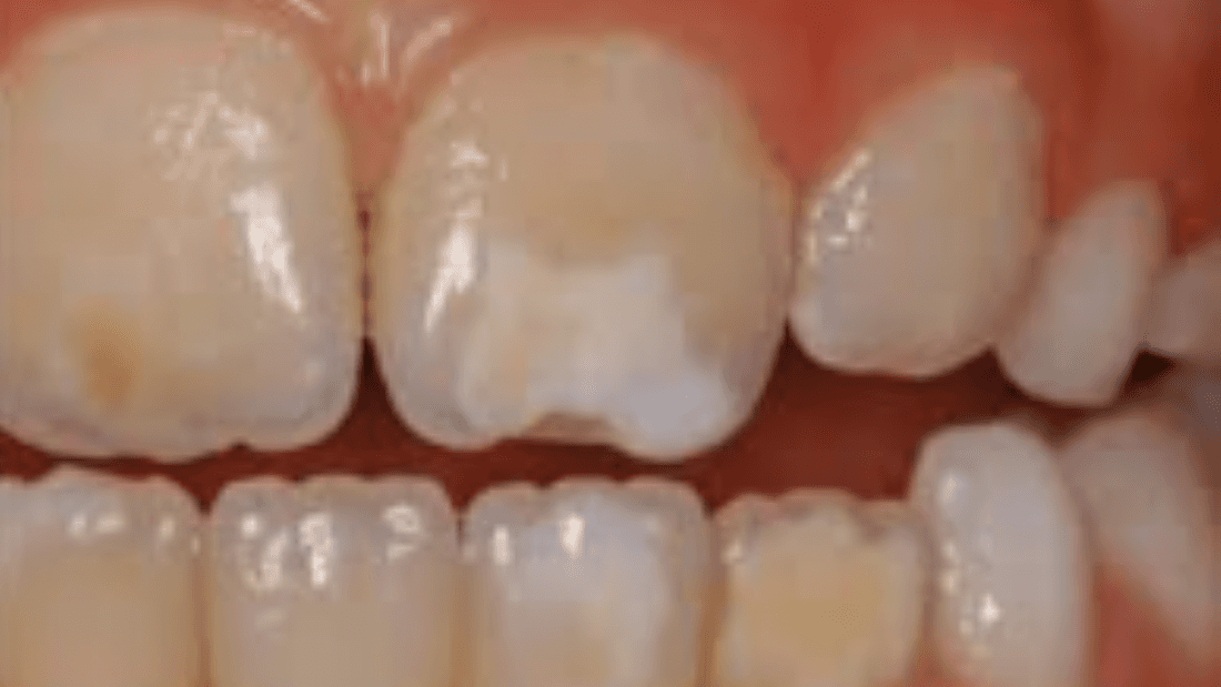 What is hypomineralisation? | Cosmetic Dentistry Auckland NZ